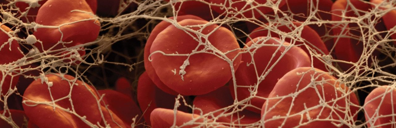 Episode 2: Why is cancer considered a hypercoagulable state? – The ...