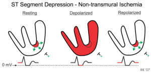 Episode 20: Why do myocardial infarctions cause ST elevation? – The ...
