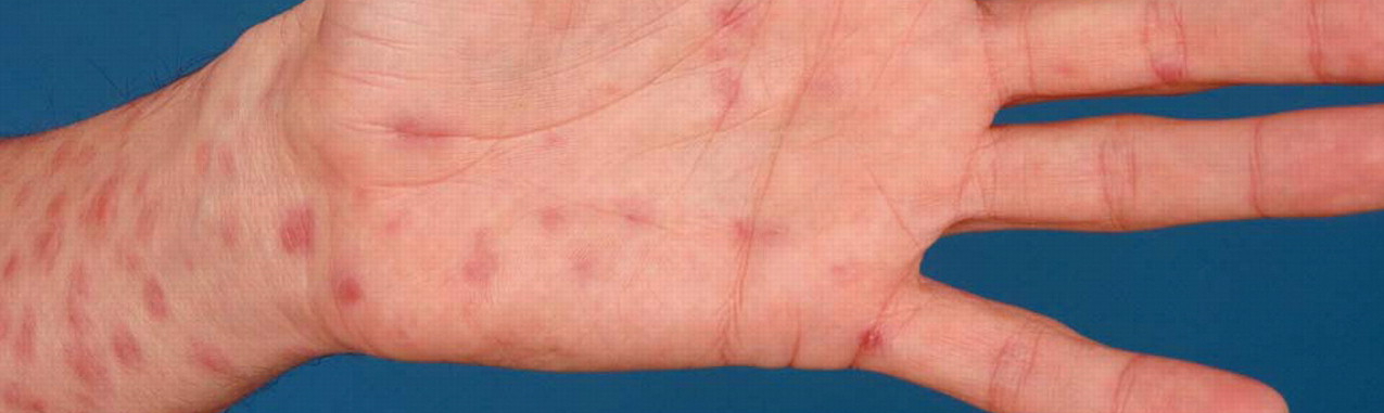 Episode 42 – A Solely Acral Rash – The Curious Clinicians